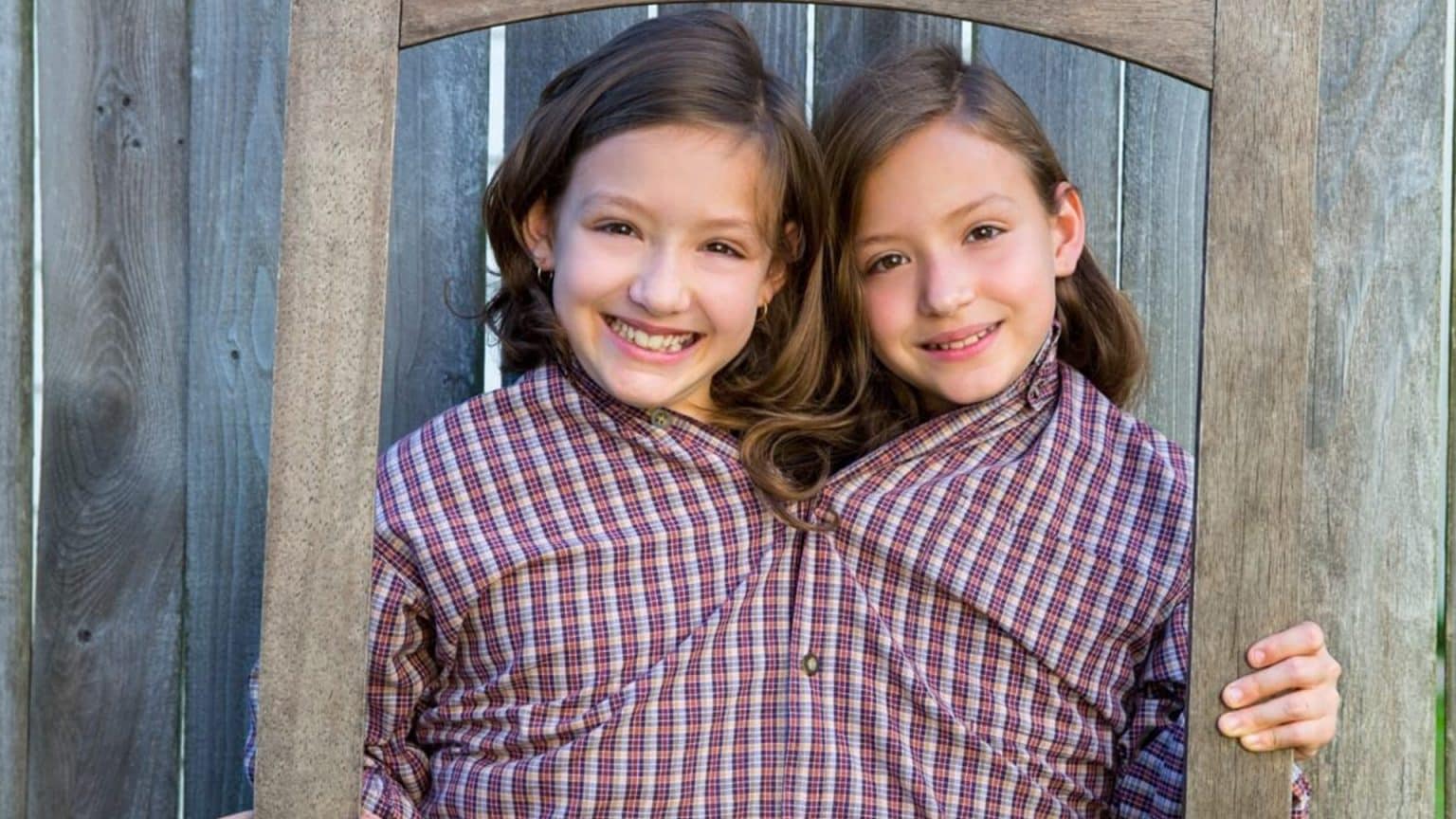 What happens when one conjoined twin dies?